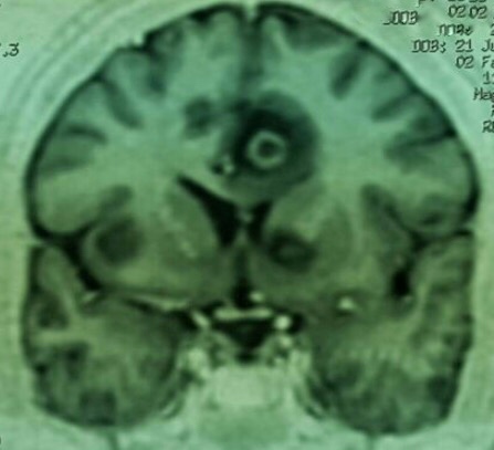Imagem: Neurotoxoplasmose | blog infectologia em geral